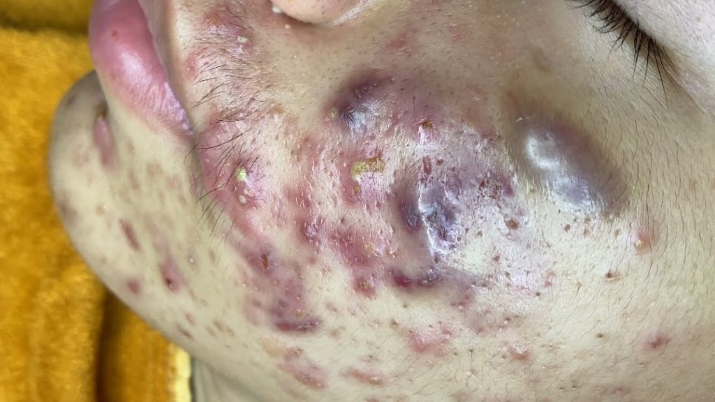 Severe Inflammatory Acne and Skin Infection: Causes, Risks, and Proper ...