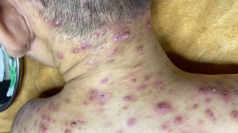 Painful Inflammatory Skin Lesions on the Neck and Upper Back: Causes ...