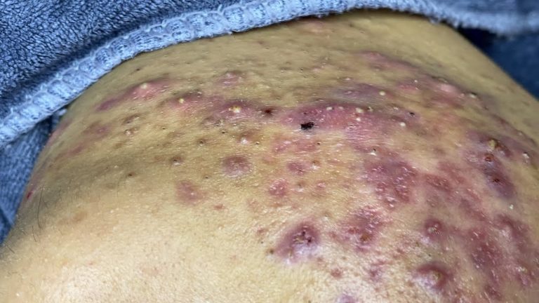 Severe Inflammatory Acne: Causes, Stages, and Treatment Options🌙 ...