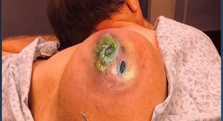 🍒Severe Infected Skin Abscess on the Upper Back: Causes, Risks, and ...
